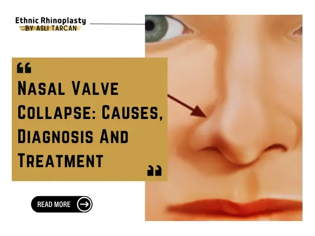 Nasal Valve Collapse: Causes, Diagnosis And Treatment
